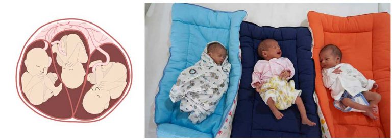 Pregnant with Triplets: A Realistic Look at Triplet Pregnancy and ...