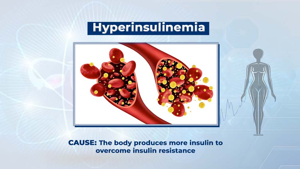 PCOS Causes Explained: From Hormonal Imbalance to Insulin Resistance ...